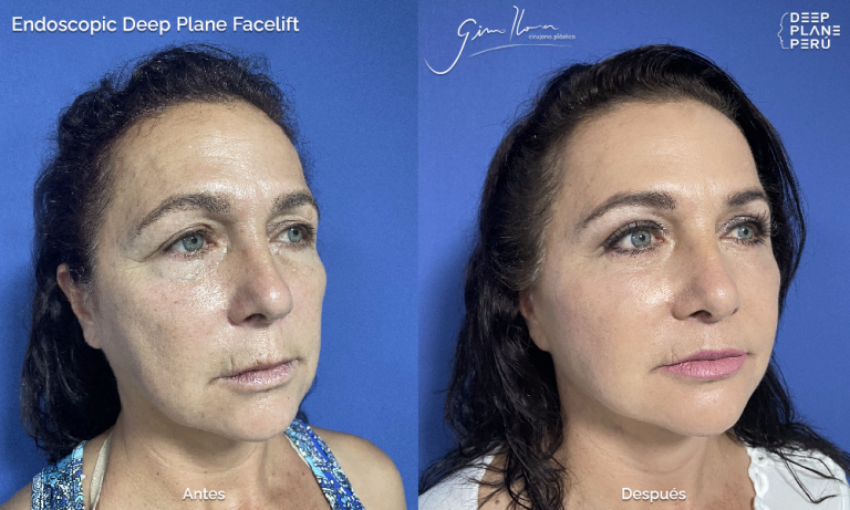 Endoscopic Deep Plane Facelift (Lifting Facial de Planos Profundos por ...
