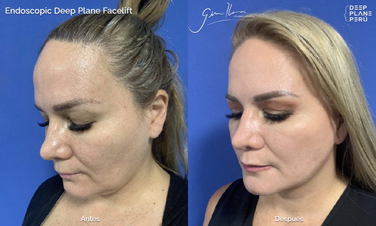 Endoscopic Deep Plane Facelift (Lifting Facial de Planos Profundos por ...
